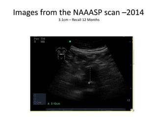 CASE study - Norfolk and Waveney AAA Screening programme | PPTX