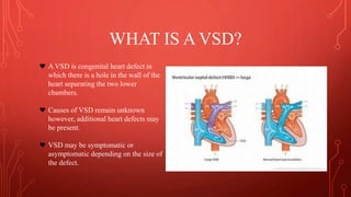 Ventricular Septal Defect | PPTX