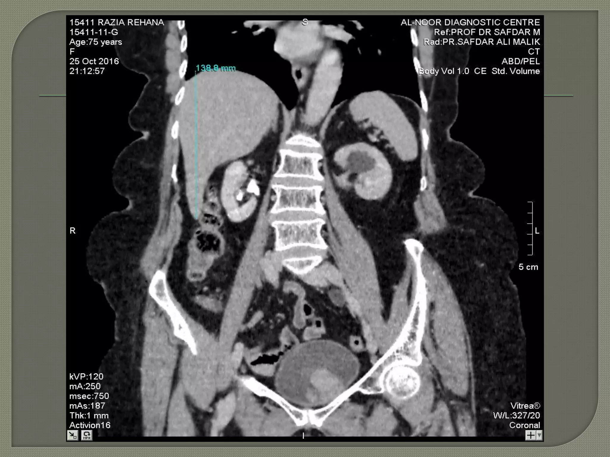 Urinary Bladder Mass | PPTX