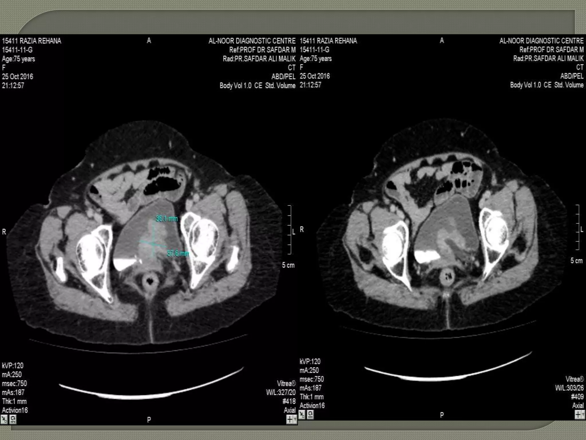 Urinary Bladder Mass | PPTX