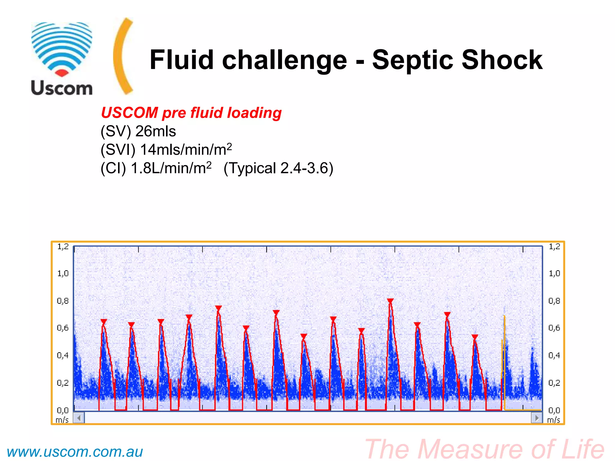 Case study - Adult - Fluid Challenge Septic Shock | PPTX