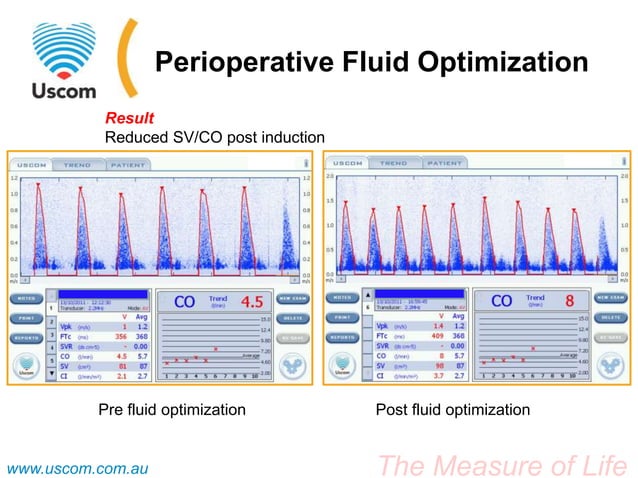 Case Study - Adult - Fluid Optimization - Perioperative | PPT