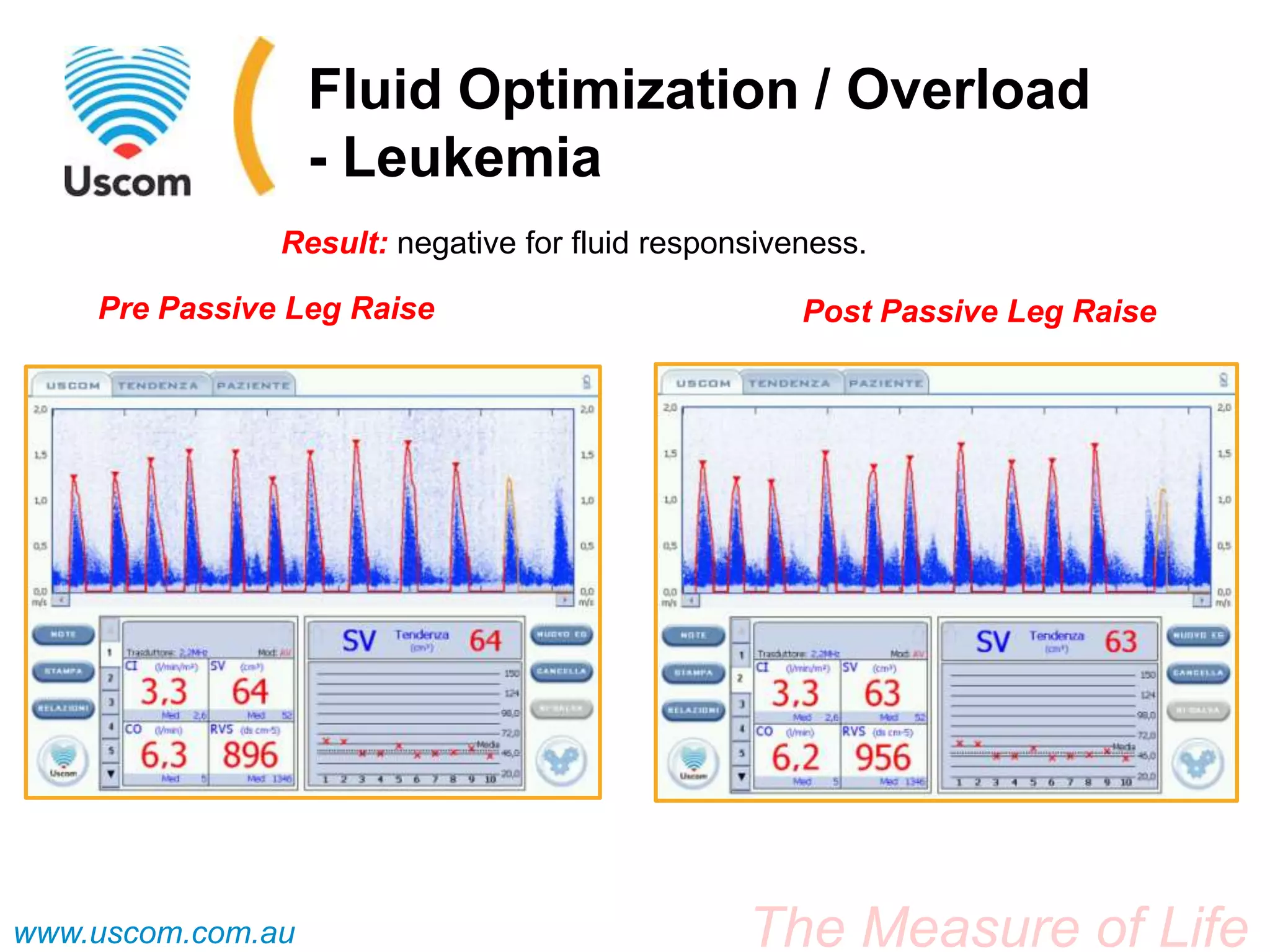 Case study - Adult - Fluid Overload - Leukemia | PPTX | Heart and ...