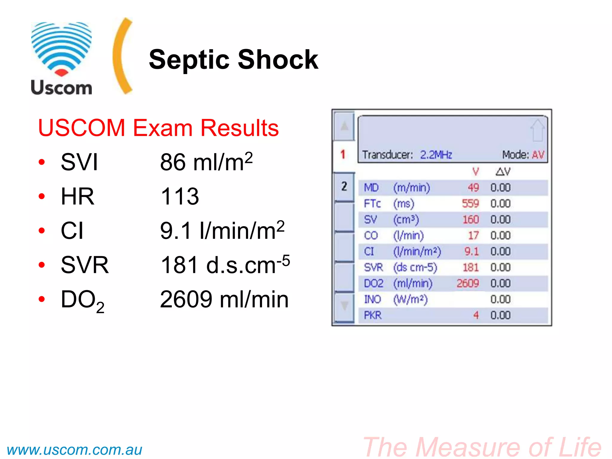 Case Study - Adult - High Output Cardiac Failure - Inotropes, Inotropy ...