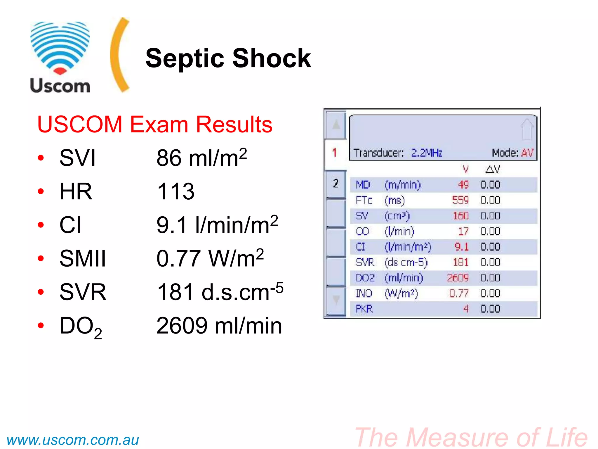 Case Study - Adult - High Output Cardiac Failure - Inotropes, Inotropy ...