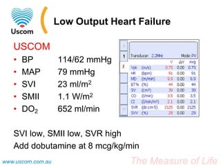 Case Study - Adult - High Output Cardiac Failure - Inotropes, Inotropy ...