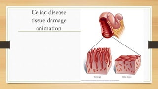 Case study: Celiac disease | PPTX