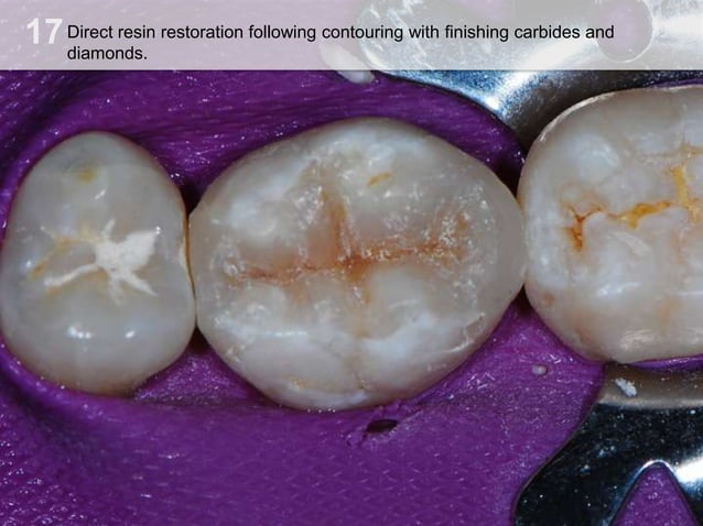 Improving Proximal Contours for Direct Resin Restorations By Dr Gregori ...