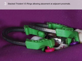 Improving Proximal Contours for Direct Resin Restorations By Dr Gregori ...