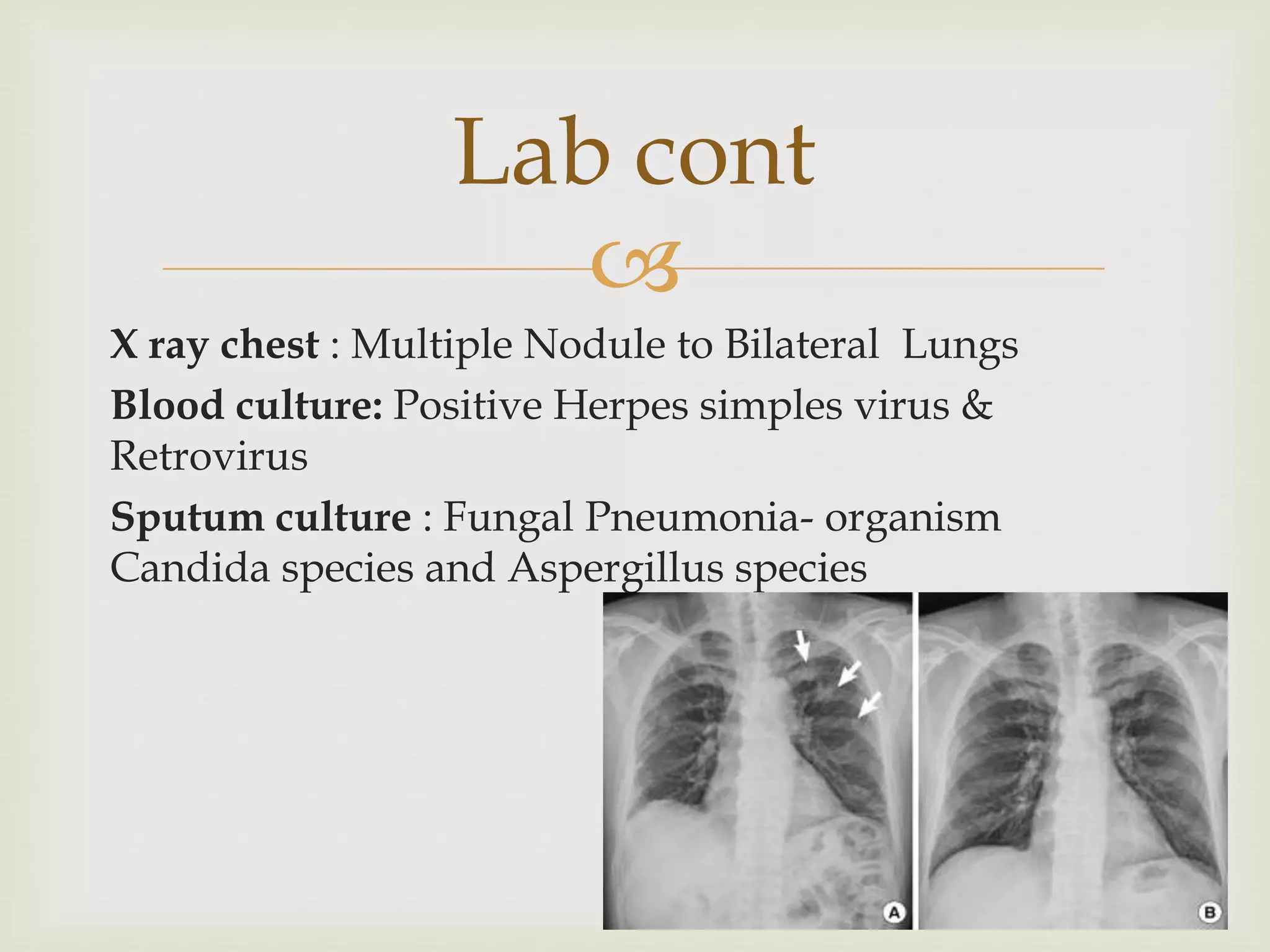 Case study HIV | PPTX