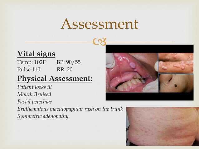 Case study HIV | PPTX | Lung and Respiratory Health | Diseases and ...