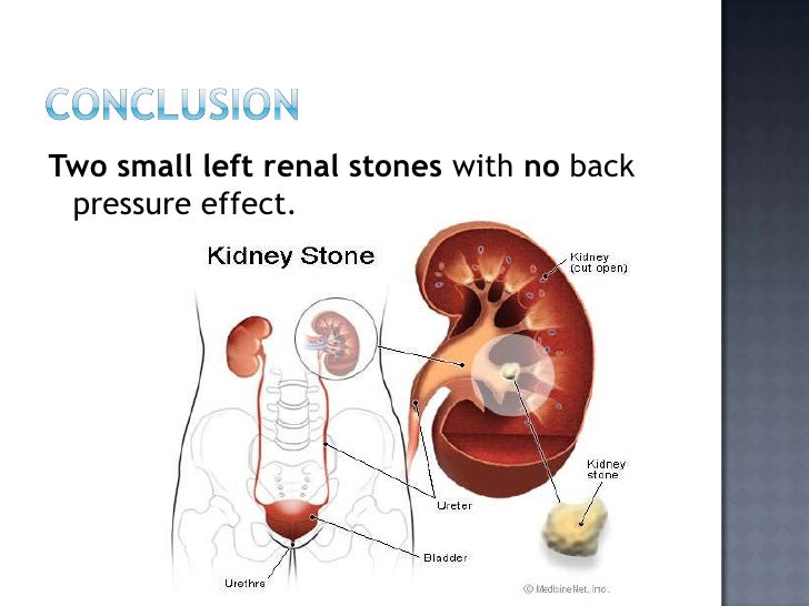 solitary kidney with a stone, Ivu cas study