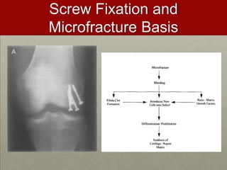 Case Study Meniscus Tears And Osteochondral Fractures | PPTX