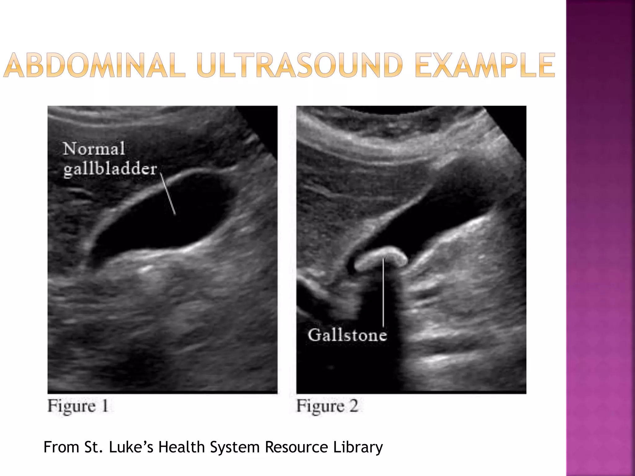 Case study on cholelithiasis | PPTX