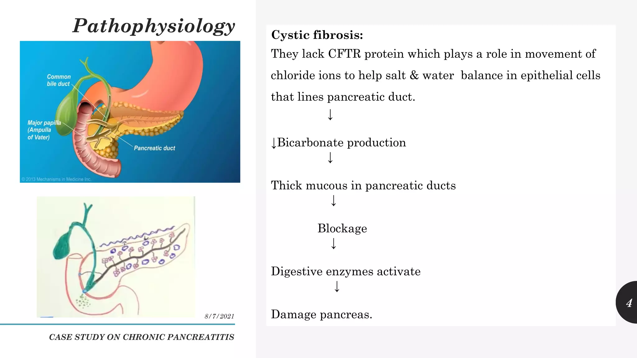Case study on chronic pancreatitis | PDF