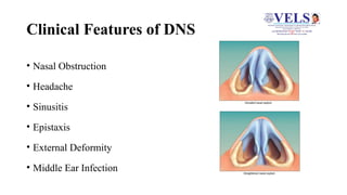 Case Study on Deviated Nasal Septum (DNS) | PPTX