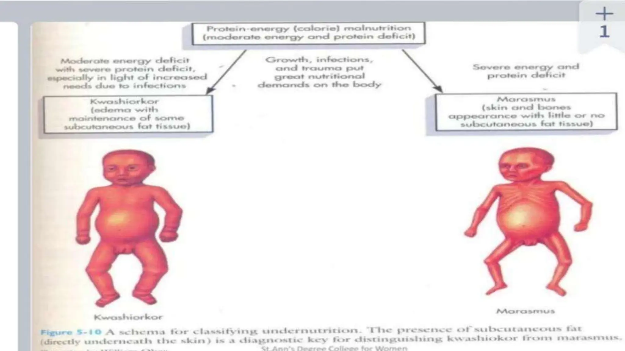 Case study on Marasmus and Kwashiorkor.pptx