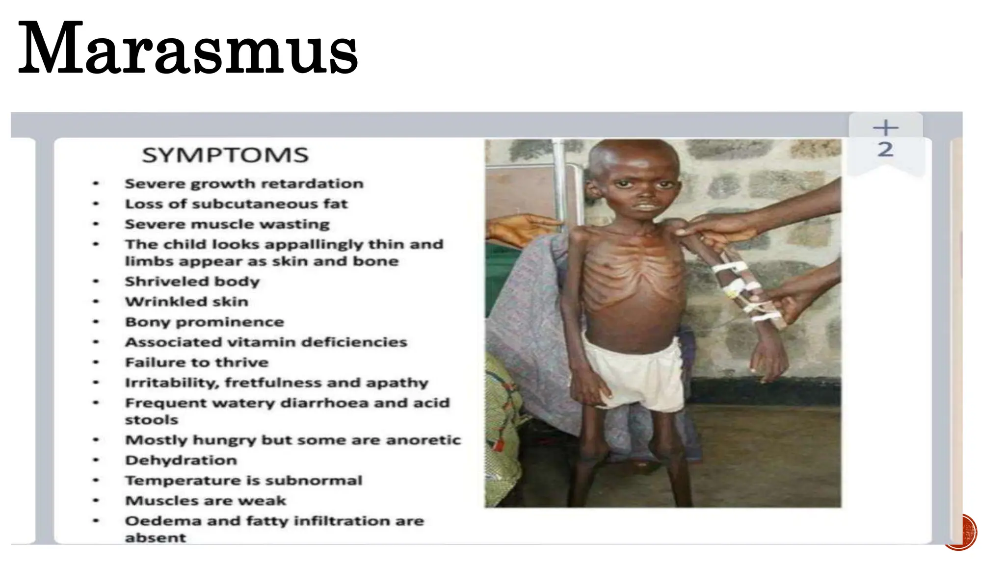 Case study on Marasmus and Kwashiorkor.pptx