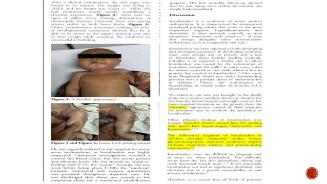 Case study on Marasmus and Kwashiorkor.pptx