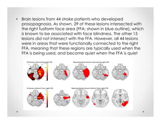 Prosopagnosia case study (Facial Blindness) by Umme Habeeba A Pathan | PPT