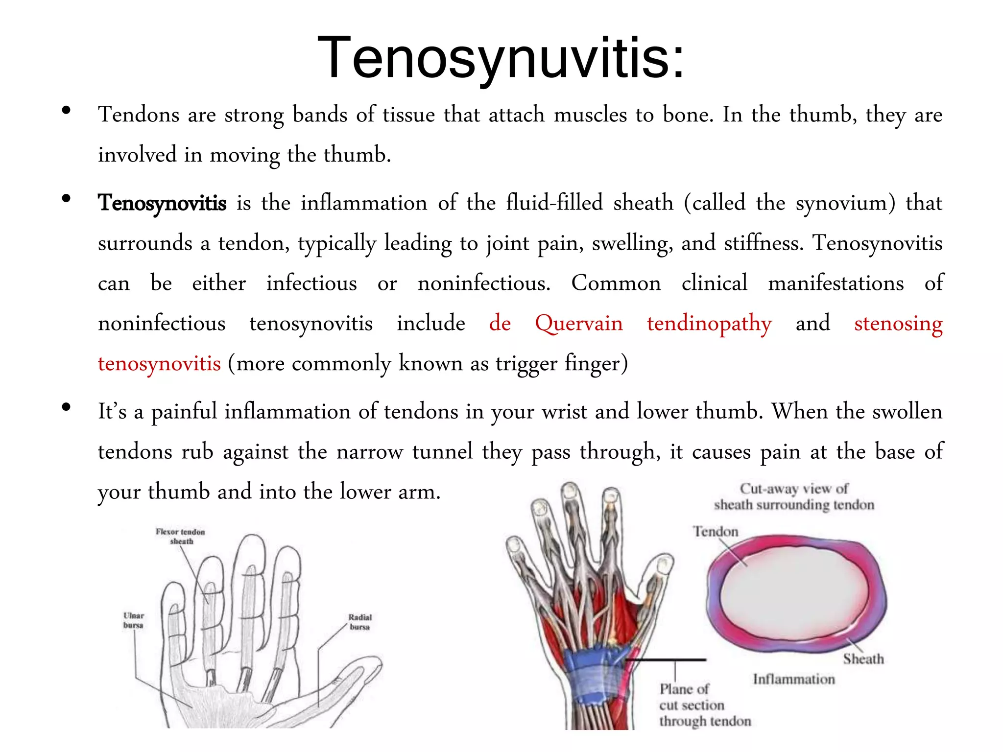 Case study on tenosynovitis | PPTX