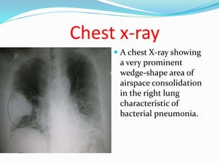 Case study pn | PPTX