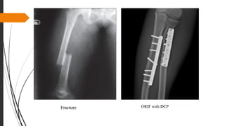 shaft of femur fracture | PDF