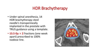 Case Study: Low Risk Prostate Cancer | PPT