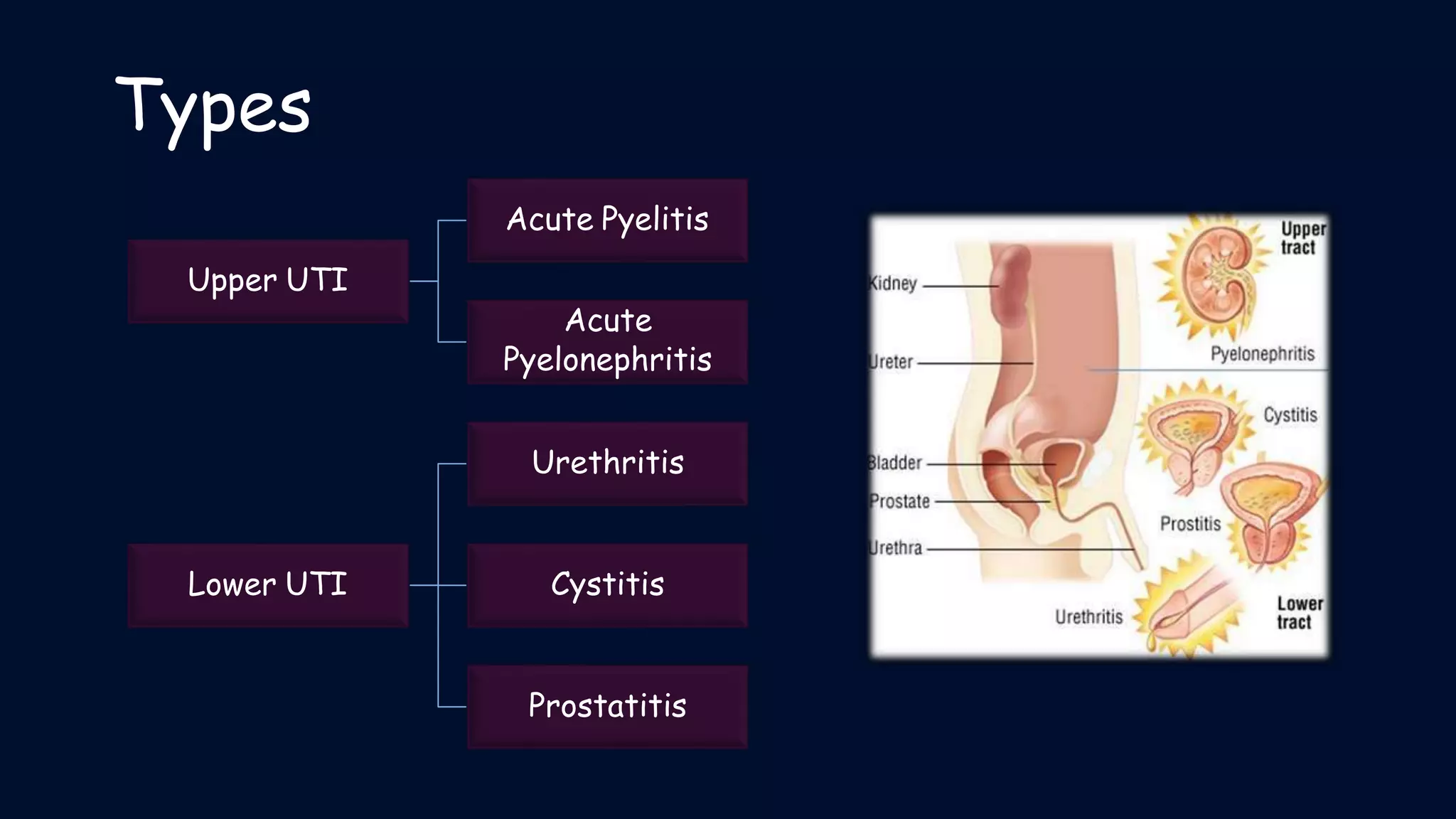 Case study of urinary tract infection | PPT