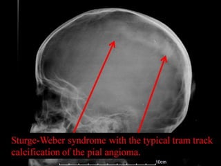 Tramline Intracranial Calcifications Sturge Weber