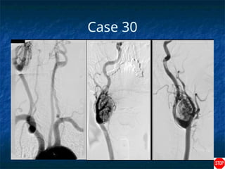 Cases vascular 2 Radiology Reporting Sample | PPTX