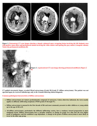 Case record...Thalamic glioma | PDF | Brain and Nervous System Disorders | Diseases and Conditions