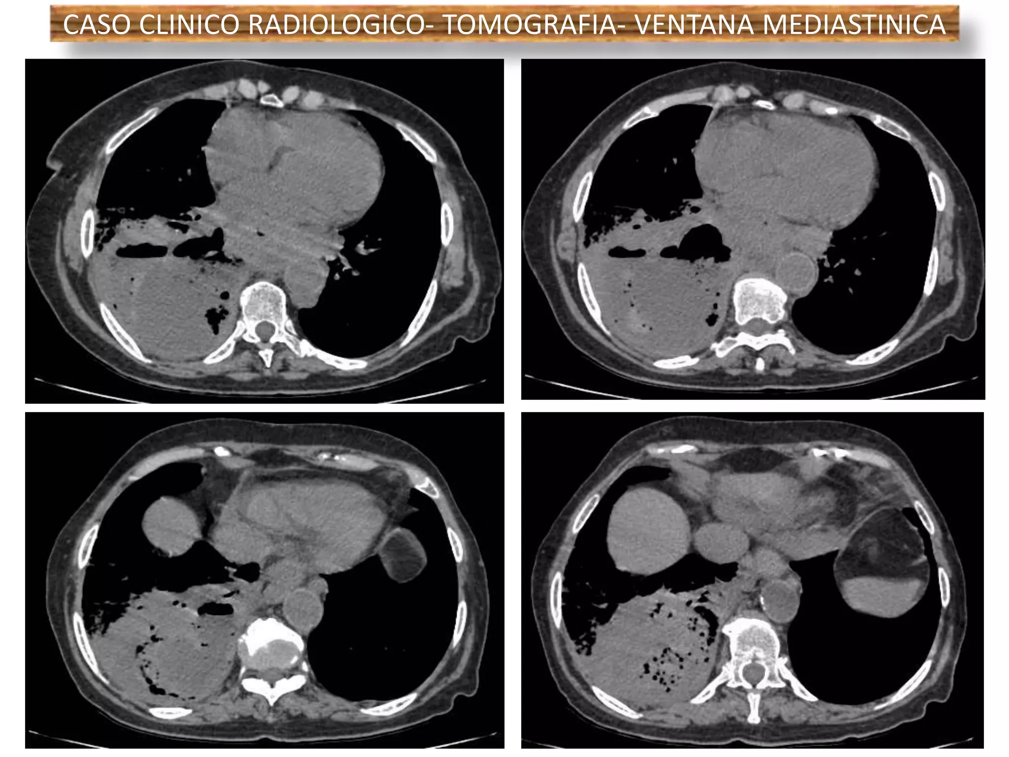 Caso Clínico Radiológico- Absceso pulmonar