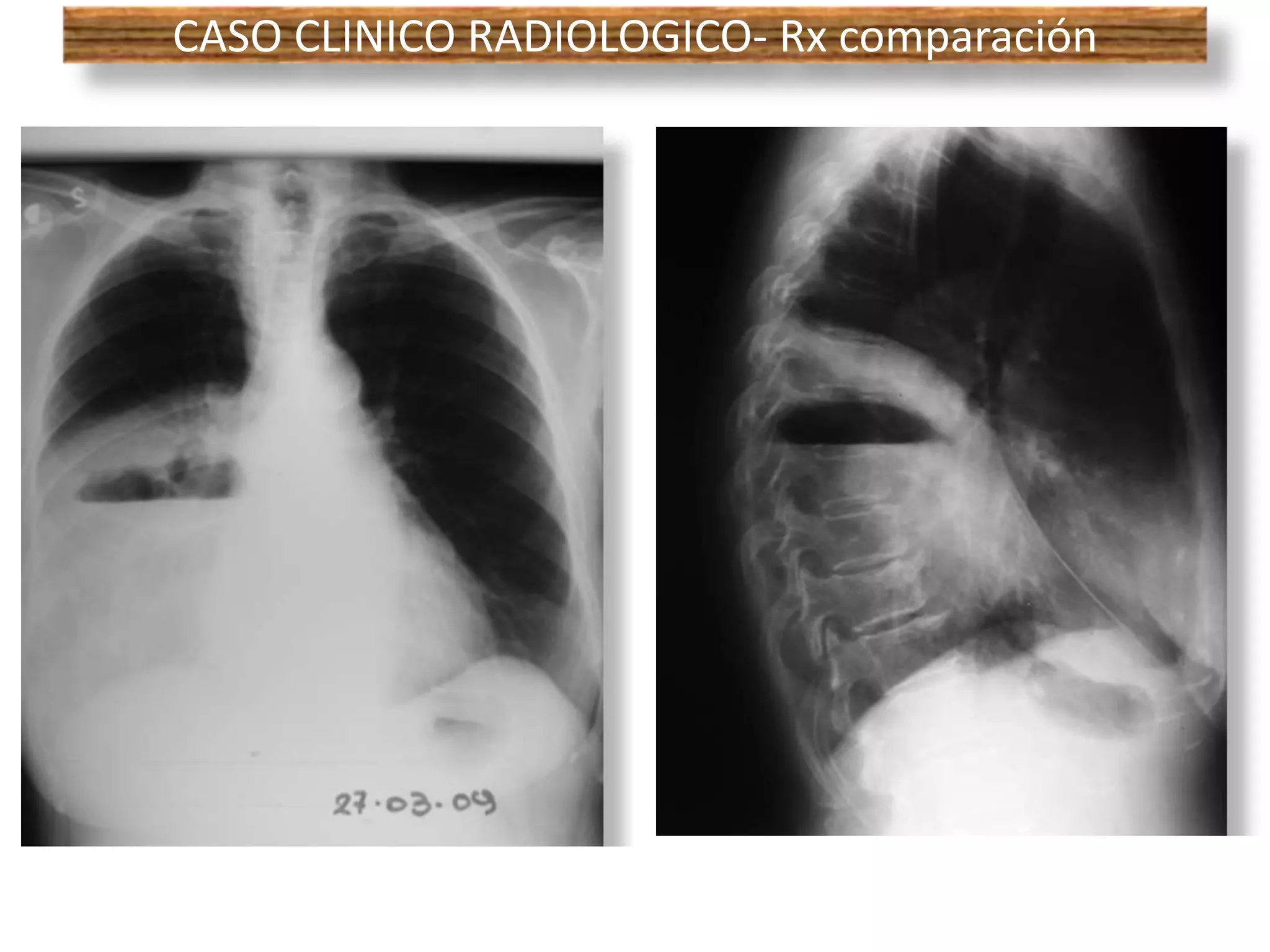 Caso Clínico Radiológico- Absceso pulmonar