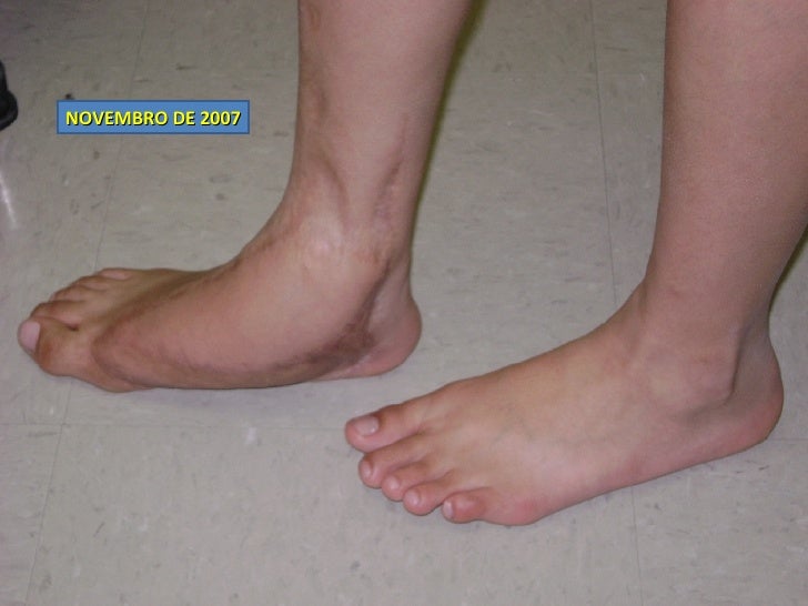 Caso de Fratura Exposta