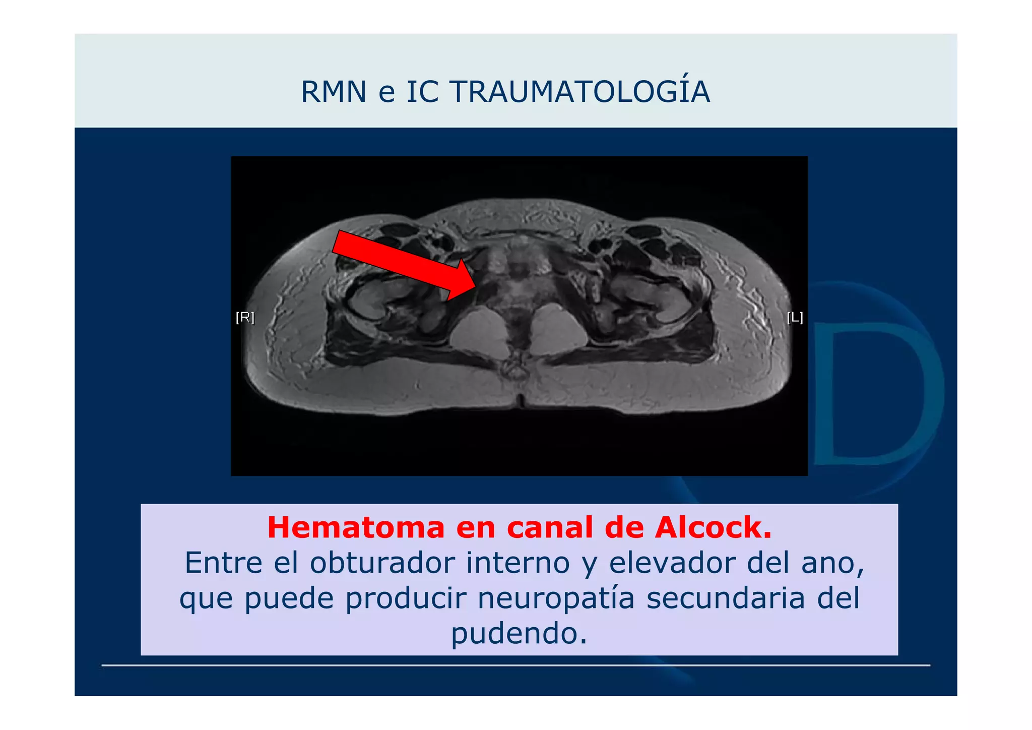 Caso Clínico: Síndrome de atrapamiento del nervio pudendo | PPT