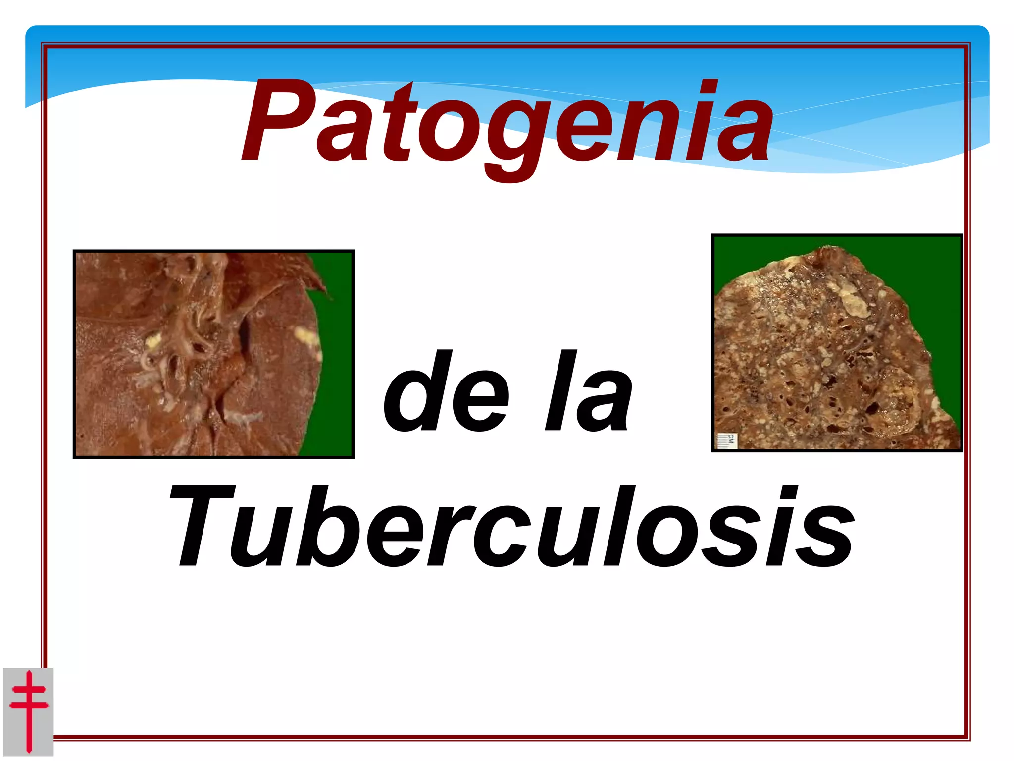 Caso Interesante tuberculosis pulmonar (bulas) | PPTX