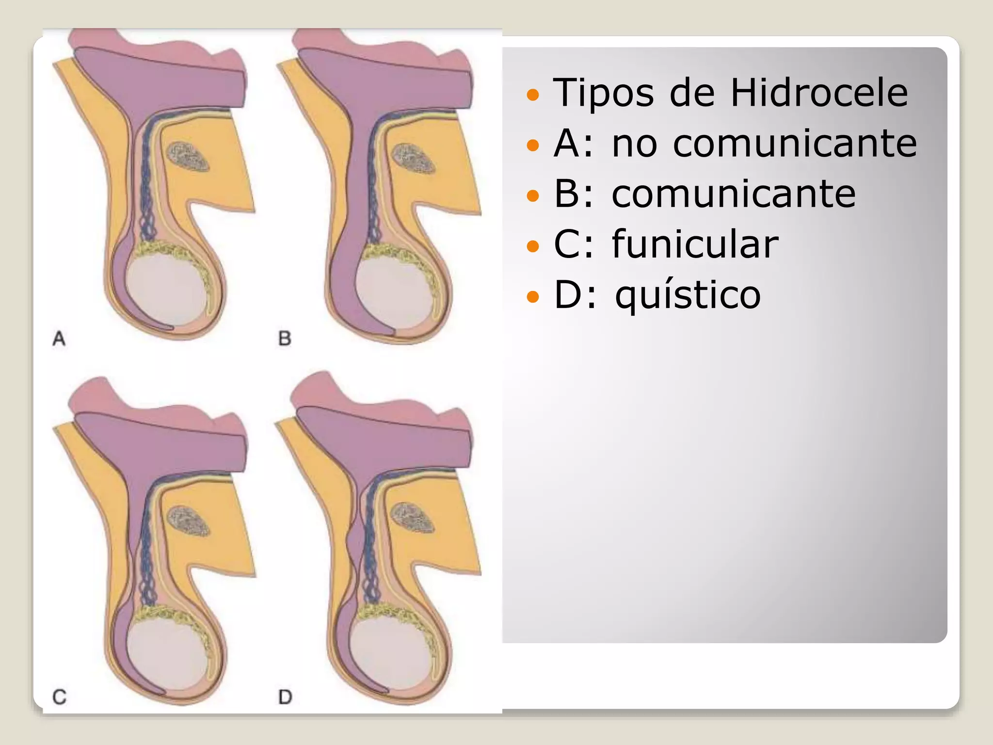 Caso 2 HIDROCELE ESPERMATICO marzo 2022.pptx