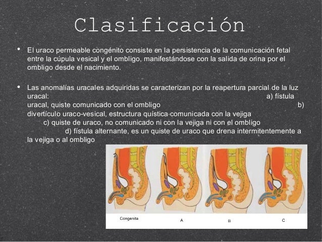 Caso 4 -2 Persistencia de Uraco