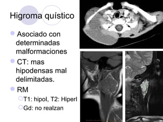 Caso cerrado 7 Abril: Atresia traqueal y bronquial con hipoplasia ...