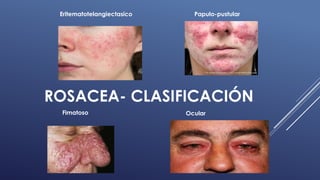 ROSACEA OCULAR CASO CLINICO DIAGNOSTICO Y TRATAMIENTO | PPTX