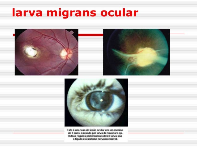 Ocular Larva Migrans.