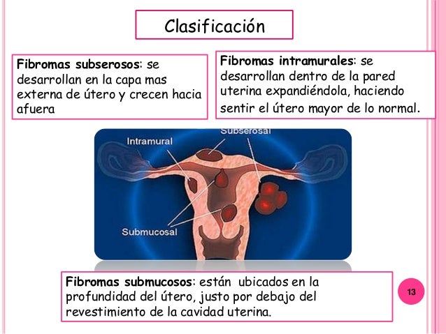 Caso clinico. Fibromatosis Uterina