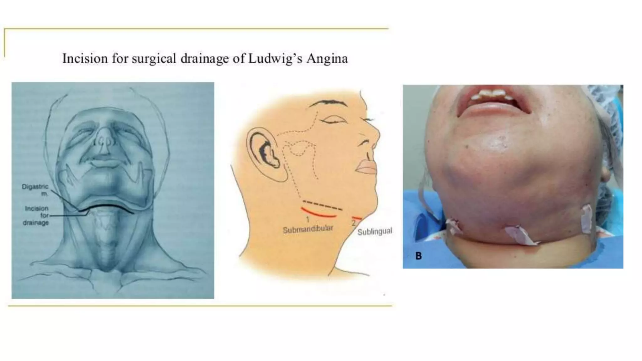 CASO CLÍNICO 3 ANGINA LUDWIG.pptx