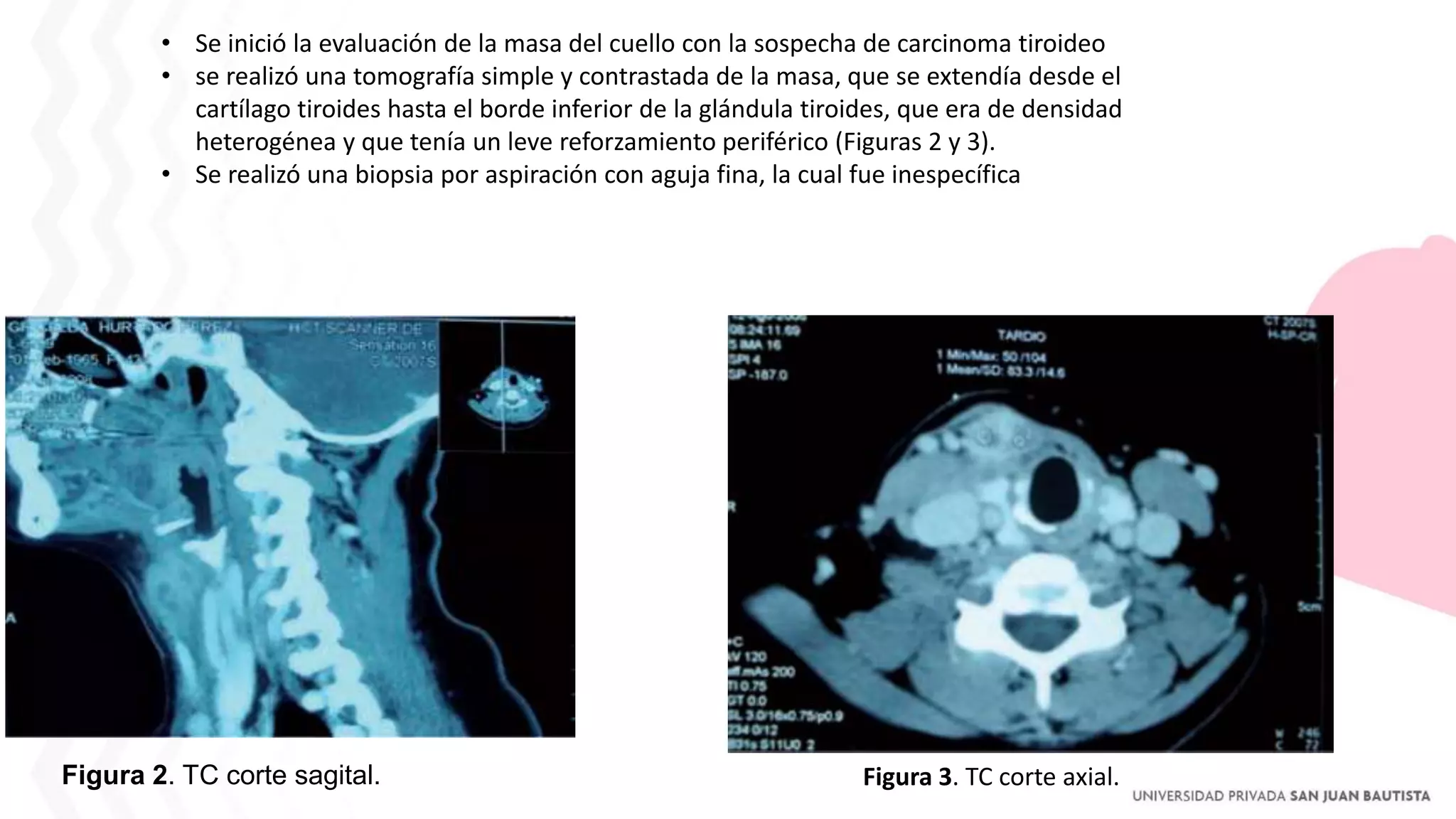 CASO CLINICO Actinomicosis cervicofacial.pptx