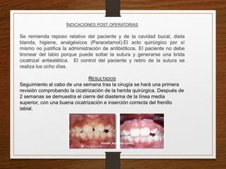 CASO_CLINICO_CIRUGIA_FRENILLO.pptx