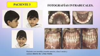Caso clinico de mal oclusiones en niños | PPT