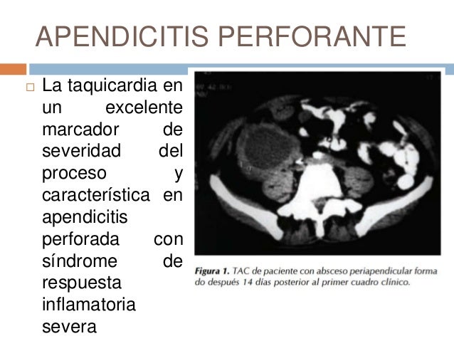 Caso clinico de paciente con apendicitis perforada