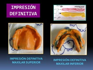 CASO CLÍNICO DE PROTESIS TOTAL | PPTX