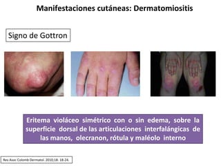 Caso clínico Dermatomiositis | PPTX